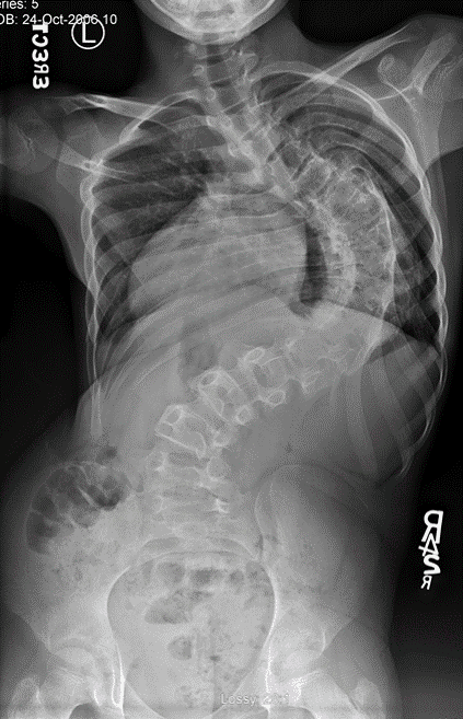 Halo-Gravity Traction in Spinal Deformity Treatment (Part 3) | Growing ...