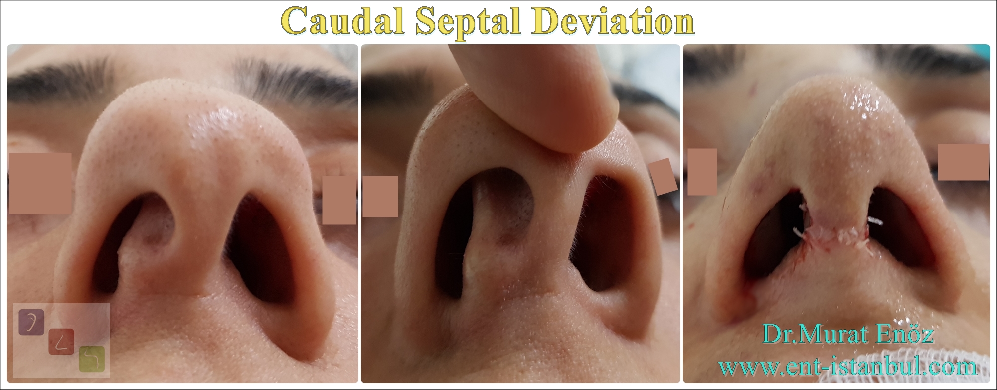 Caudal Septal Deviation