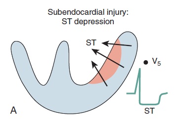 Subendocardial vs Transmural Myocardial Ischemia. - Anesthesiology and ...