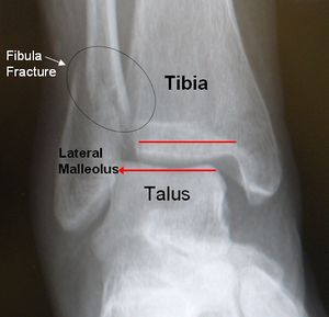 Fibular Bone Fracture Surgery | Fractured Fibular Types