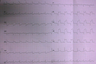 belajar membaca ekg: Acute extensive anterior MCI dengan ischemic di ...