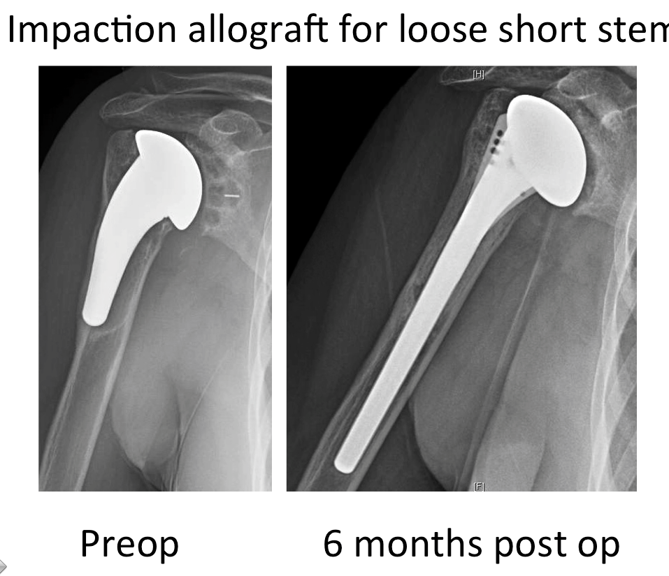 Shoulder Arthritis/Joint Replacement Rotator cuff tears: Shoulder ...