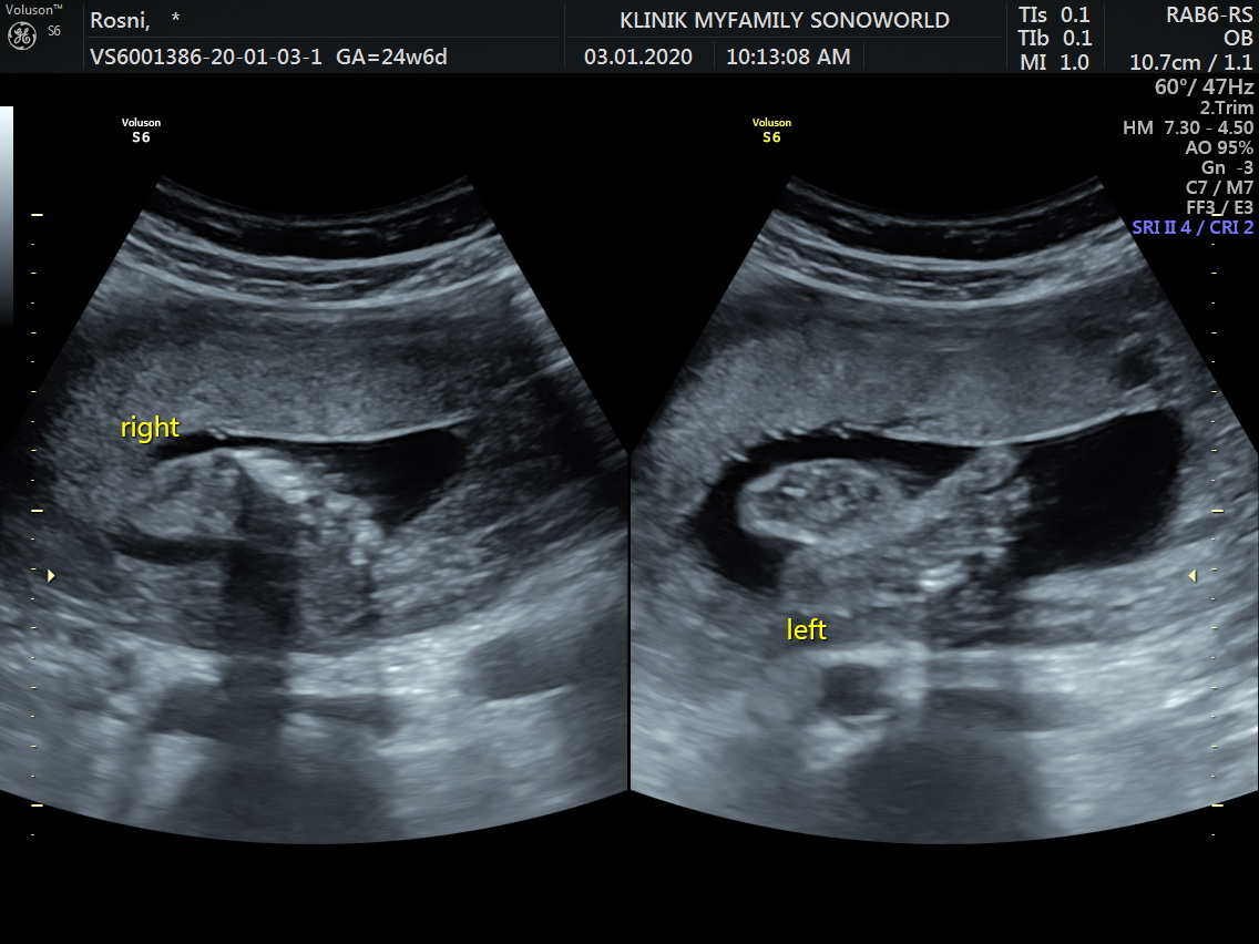 Pregnancy Journey - Buat Detail Scan di Klinik Myfamily by Mysonoworld ...