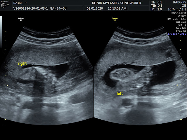 Pregnancy Journey - Buat Detail Scan di Klinik Myfamily by Mysonoworld ...