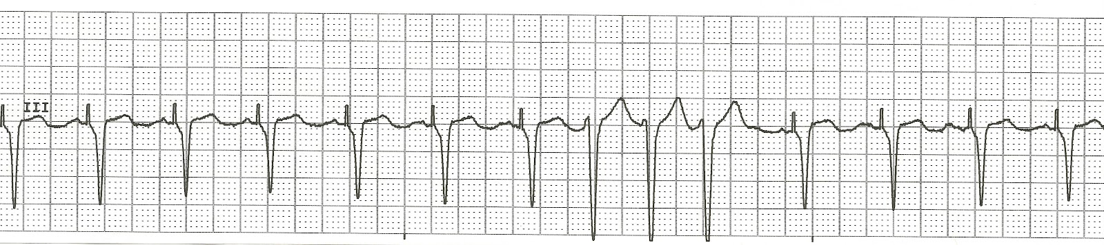 ECG Rhythm Strip Quiz 77