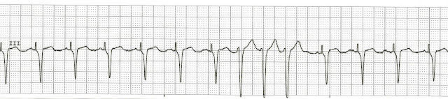 ECG Rhythm Strip Quiz 77