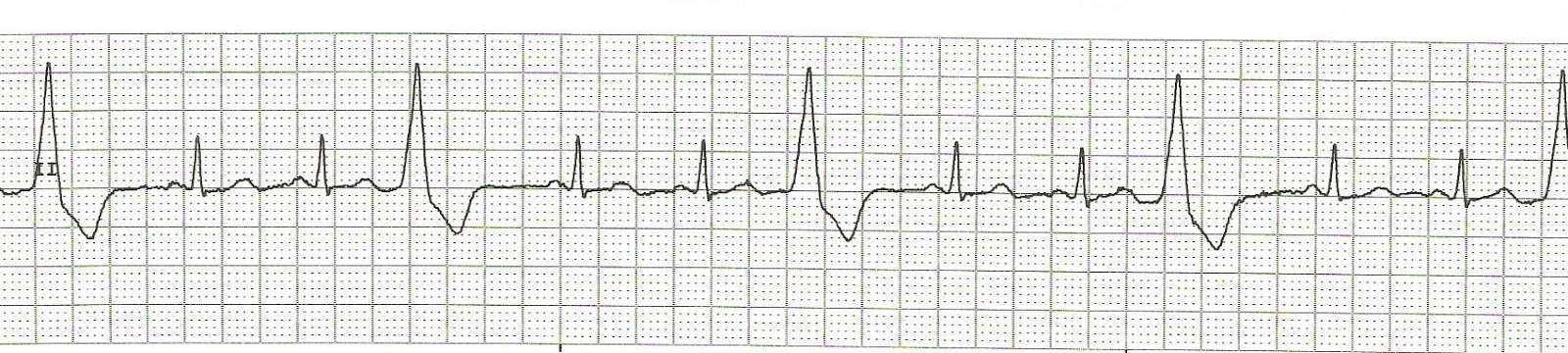 Float Nurse: EKG Rhythm Strip Quiz 64