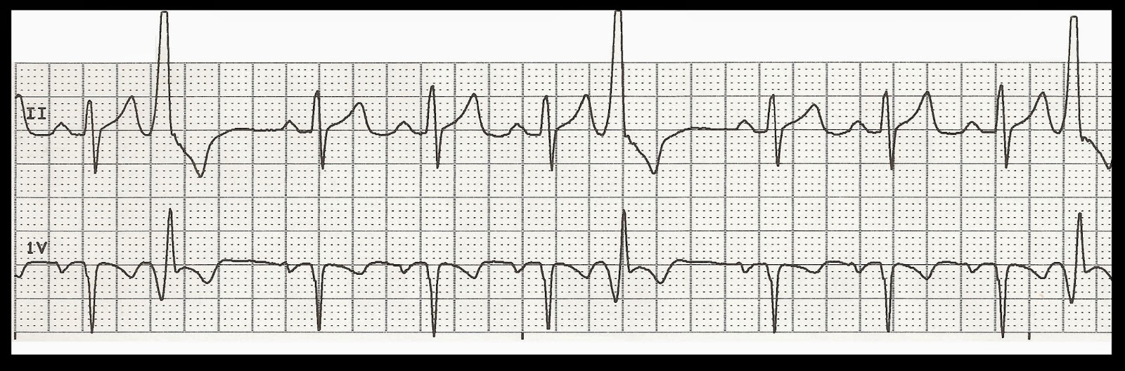 Various Quadrigeminal PVCs