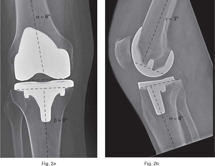 Revisiones_bibliográficas TyO_Web: Artroplastia total de rodilla con ...