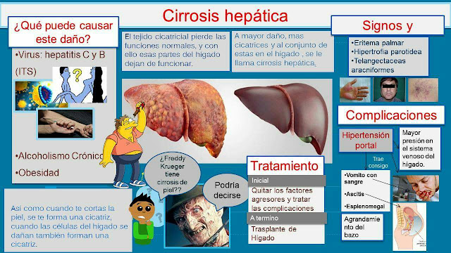 DivulgaciÓn CientÍfica Ug Cirrosis Hepática