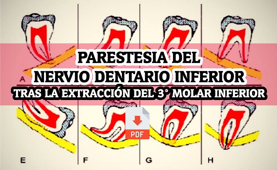 PDF: Actitud ante una posible parestesia del nervio dentario inferior ...