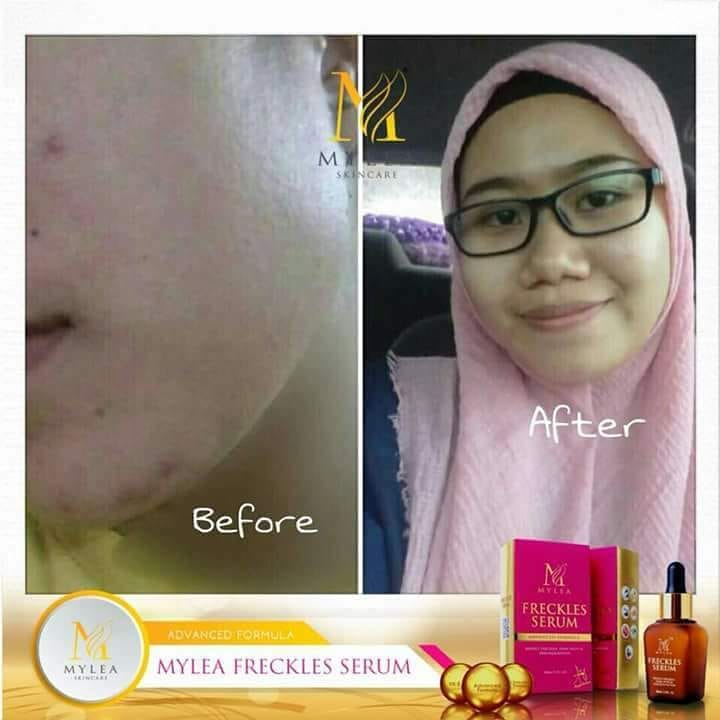 Adara Belle Store: MYLEA FRECKLES SERUM MALAYSIA