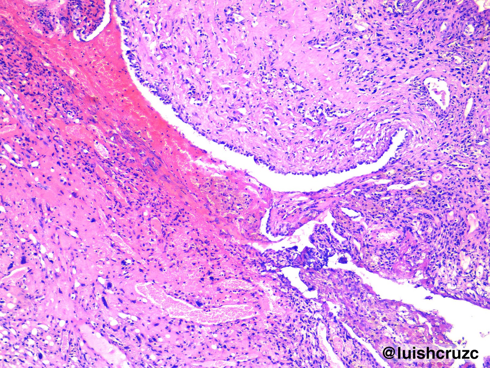 Patología CC: Blastoma pleuropulmonar tipo II / Pleuropulmonary ...