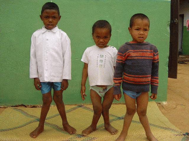 Raquitismo ~ Sintomas Causas e Curas