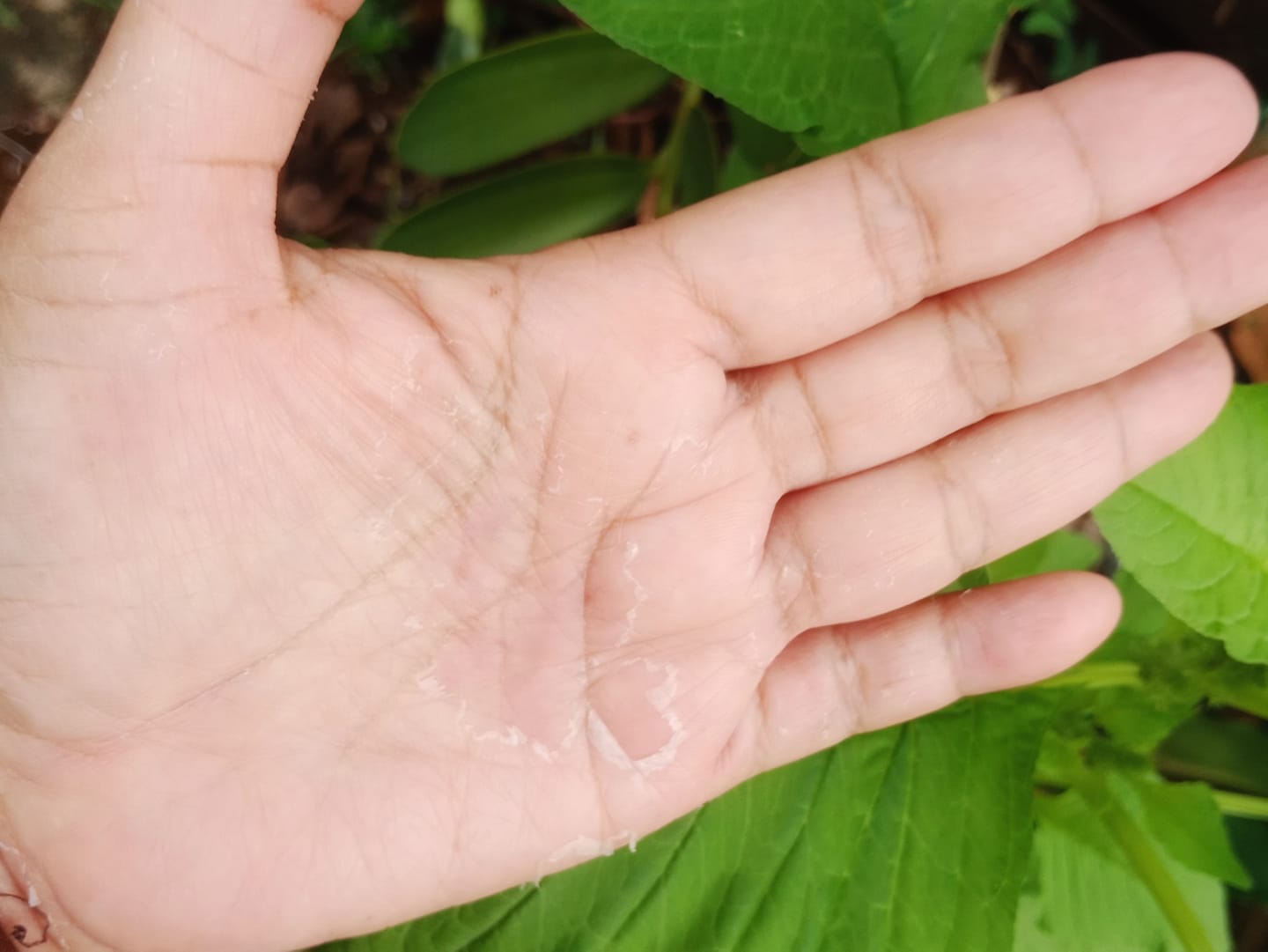 Pengalaman Luka Bakar, Lebih Sakit Dibanding Melahirkan Anak! | Curhat Si Ambu