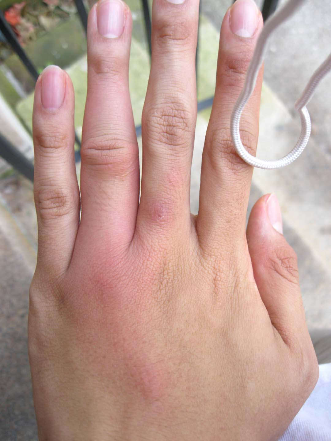 VIRTUAL GRAND ROUNDS IN DERMATOLOGY 2.0: Insect Bite Lymphangitis