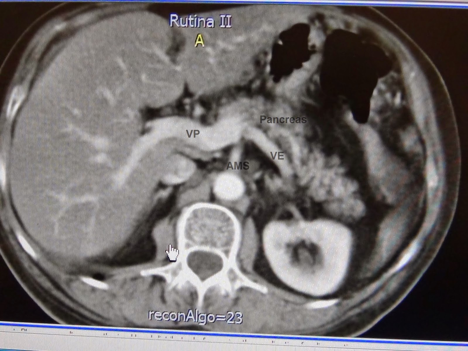 Endoscopia y Cirugía Digestiva: COMPLEJO VENA PORTA Y VENA ESPLENICA