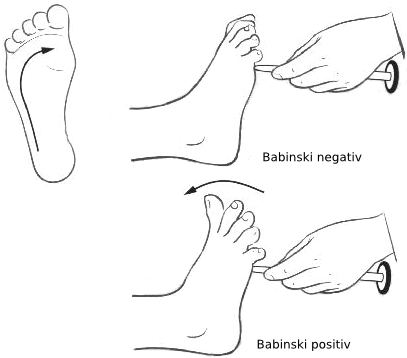 medical student: Babinski sign
