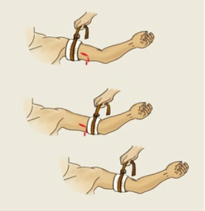 Comment poser un garrot médical ? ~ Nos Conseils de Vie