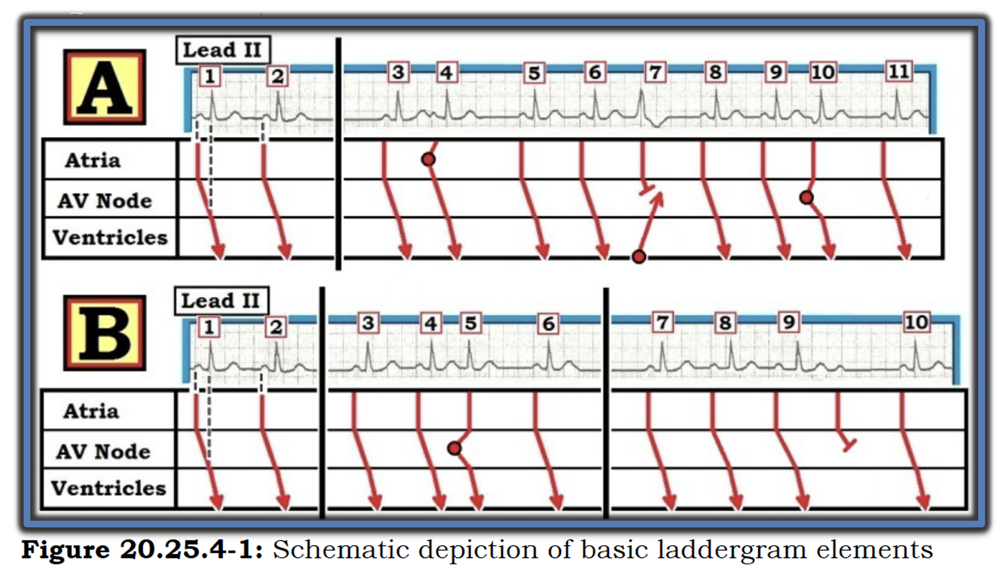 ECG Interpretation: ECG Blog #188 - How to Read/Draw Laddergrams