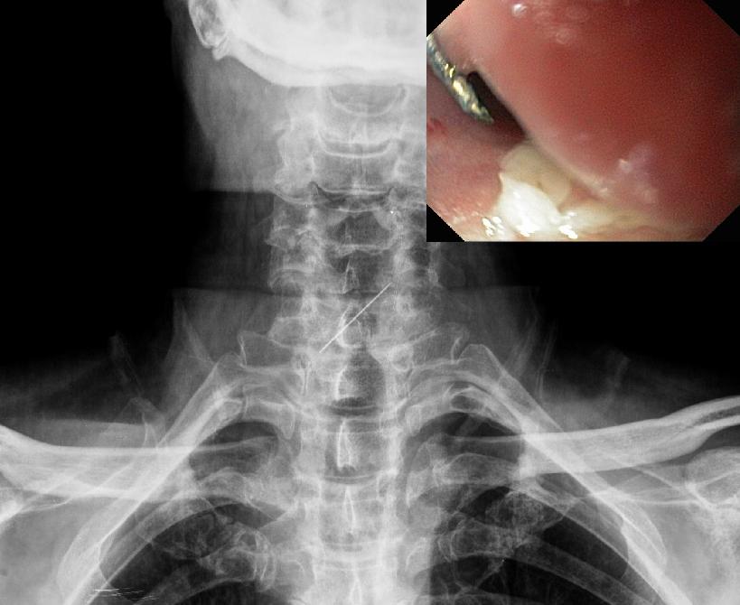 ENDOSCOPIA TERAPEUTICA Día a Día: Cuerpo Extraño en Esófago