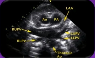 CVT Mohd Farid: Basic Echocardiography:Transthoracic Echocardiography ...