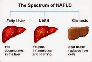 Easy Medical Terminology : Hepatic Steatosis