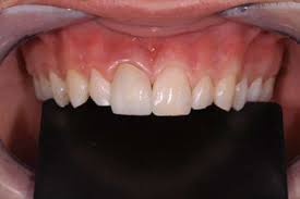Monoblocks in restorative dentistry