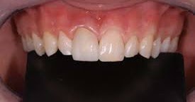 Monoblocks in restorative dentistry
