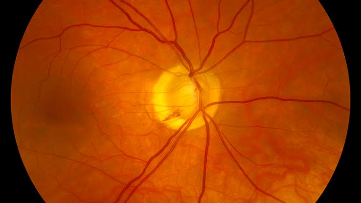 Optic atrophy treatment by sharp vision