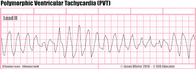 ECG Educator Blog : Six Second ECG Rhythm Strips