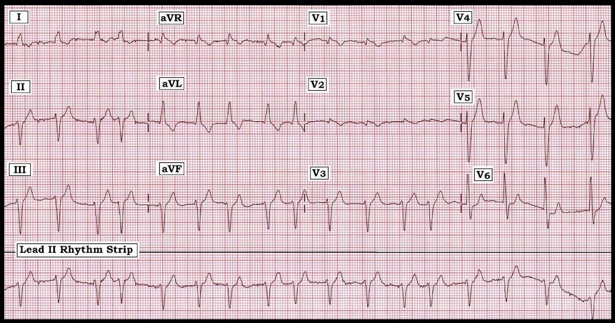 ECG Interpretation: ECG Interpretation Review #31 (A Fib – RBBB – LBBB ...