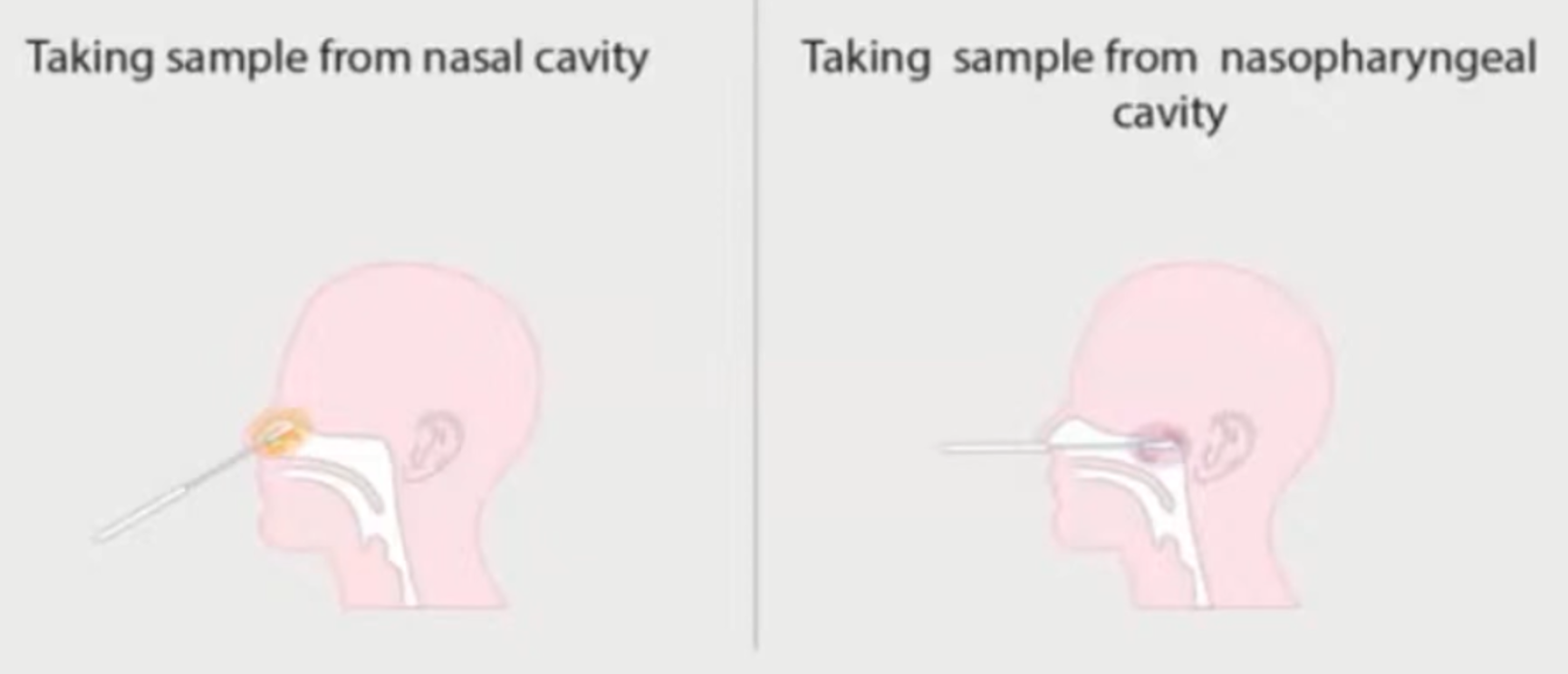 Nasofaringeal Swab atau Nasal Swab?