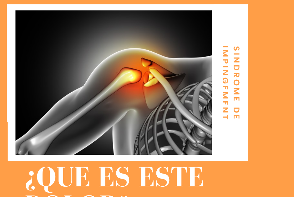 Síndrome de Impactación