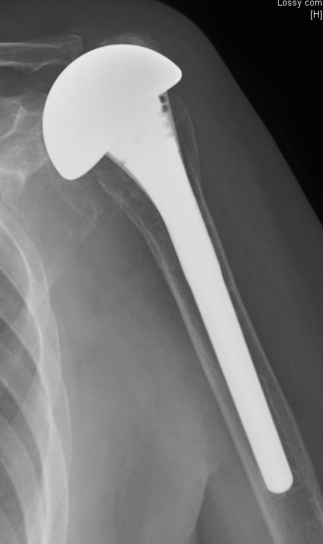 UW Shoulder and Elbow Academy: Revision of anatomic arthroplasty to ...
