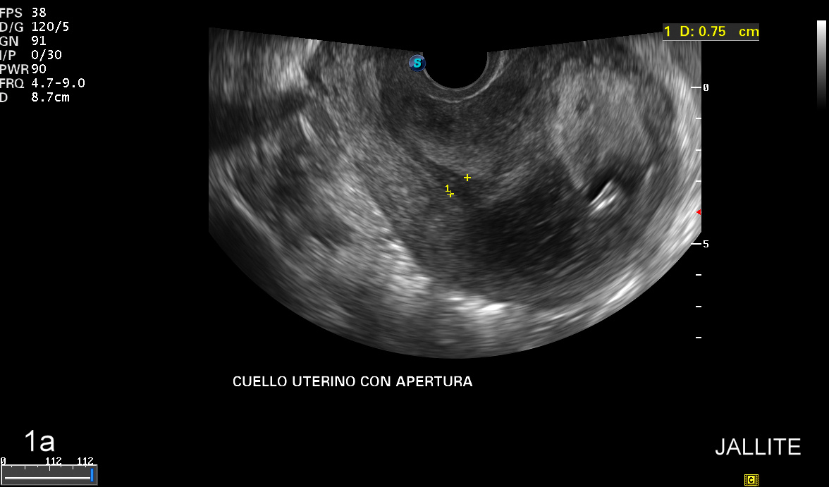 Hematoma Retrocorionico & Placenta Marginal