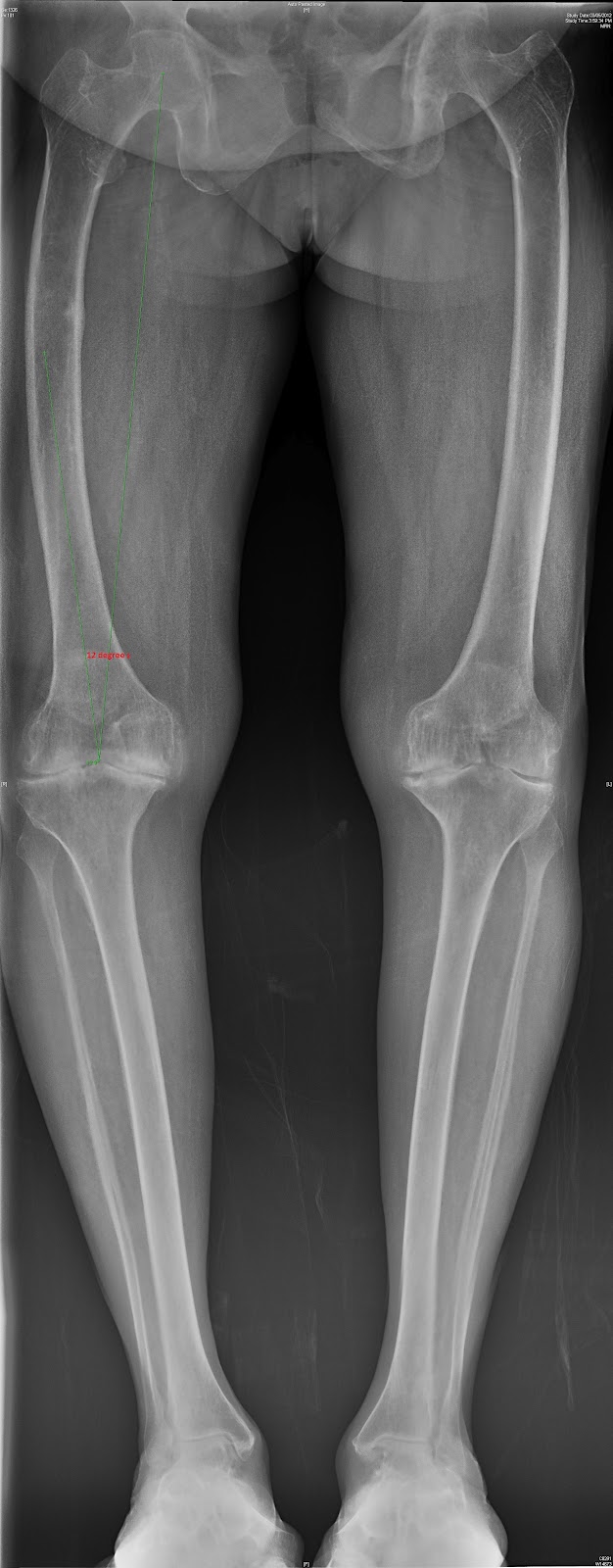 Joint Preservation and Replacement : TKR iwith a bowed femur