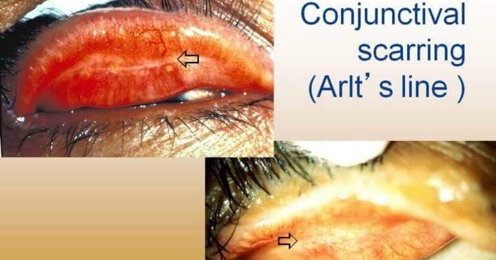 Ophthalmology Notes: Lines in Ophthalmology