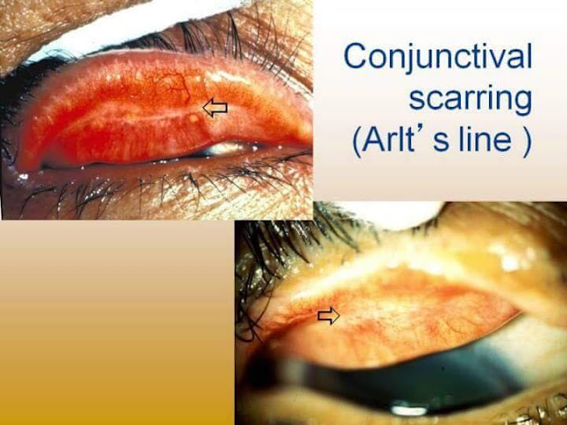 Ophthalmology Notes: Lines in Ophthalmology