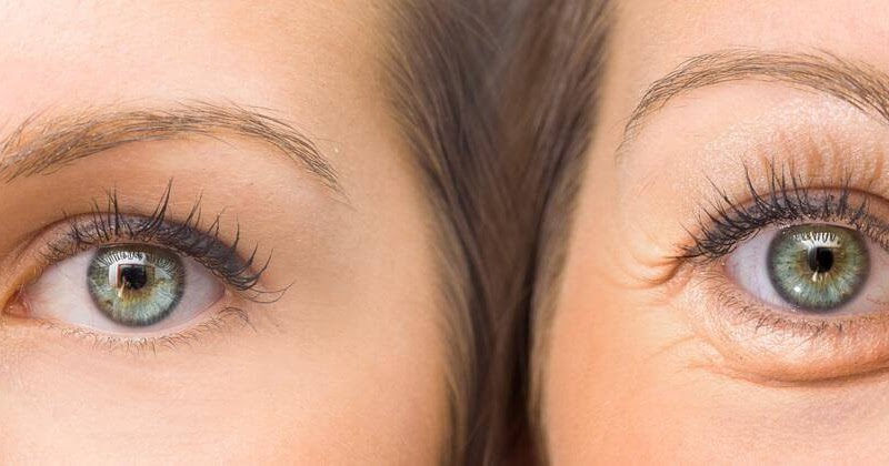 How To Tighten Droopy Eyes Naturally