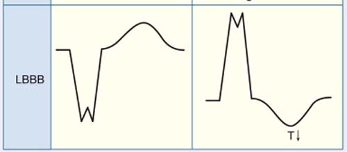 ECG T wave changes and interpretation