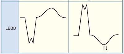 ECG T wave changes and interpretation