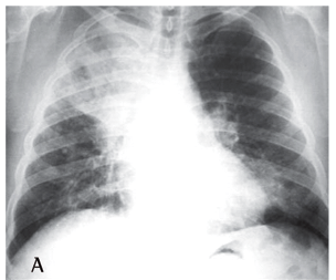 CEREST Ouricuri: PNEUMOCONIOSES RELACIONADAS AO TRABALHO