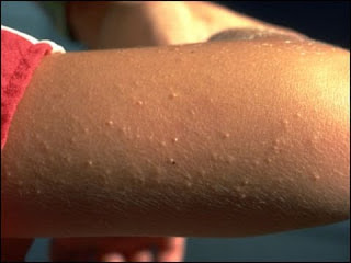 Keratosis Pilaris Cure: Chicken Skin - Bumps on Back of Arms
