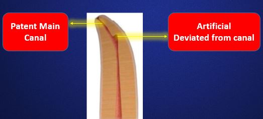 What is Ledge, Zipping, Strip Perforation and Apical Transportation in ...