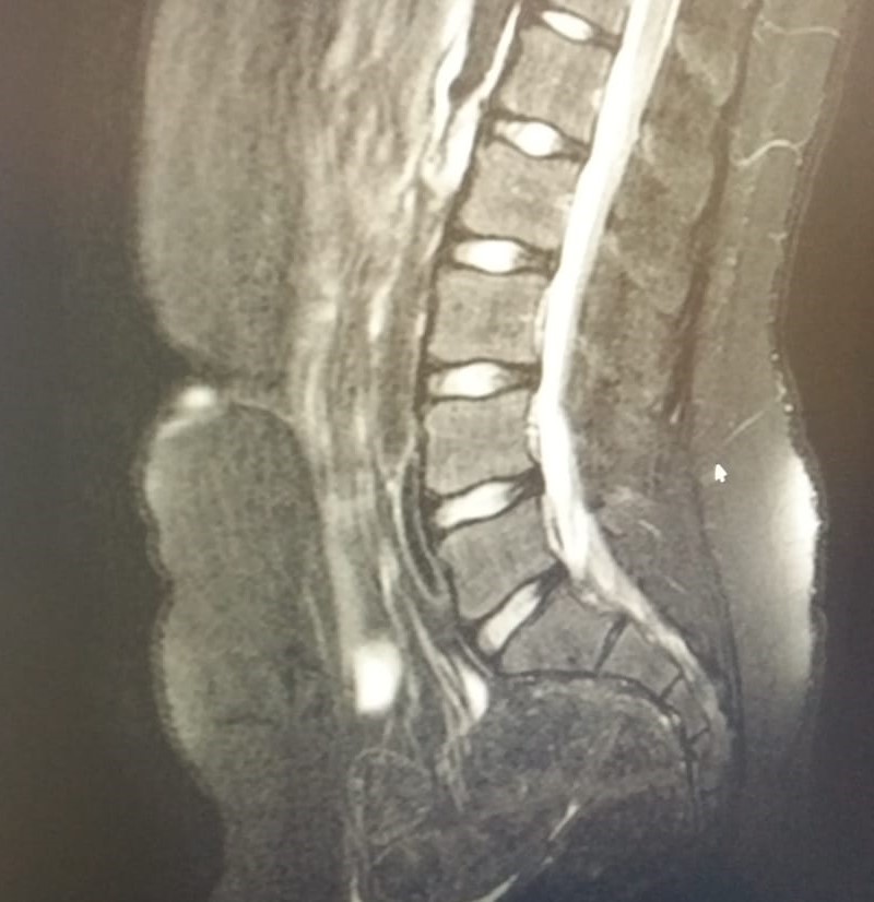 Urachal Anomaly: Case Reports - Sumer's Radiology Blog