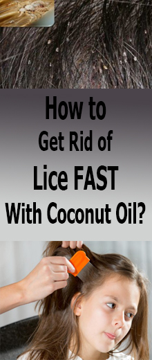 How to Get Rid of Lice FAST With Coconut Oil? - Health Tips
