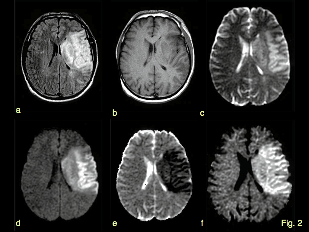 MRI BLOG: Pitfalls of Diffusion Weighted Imaging