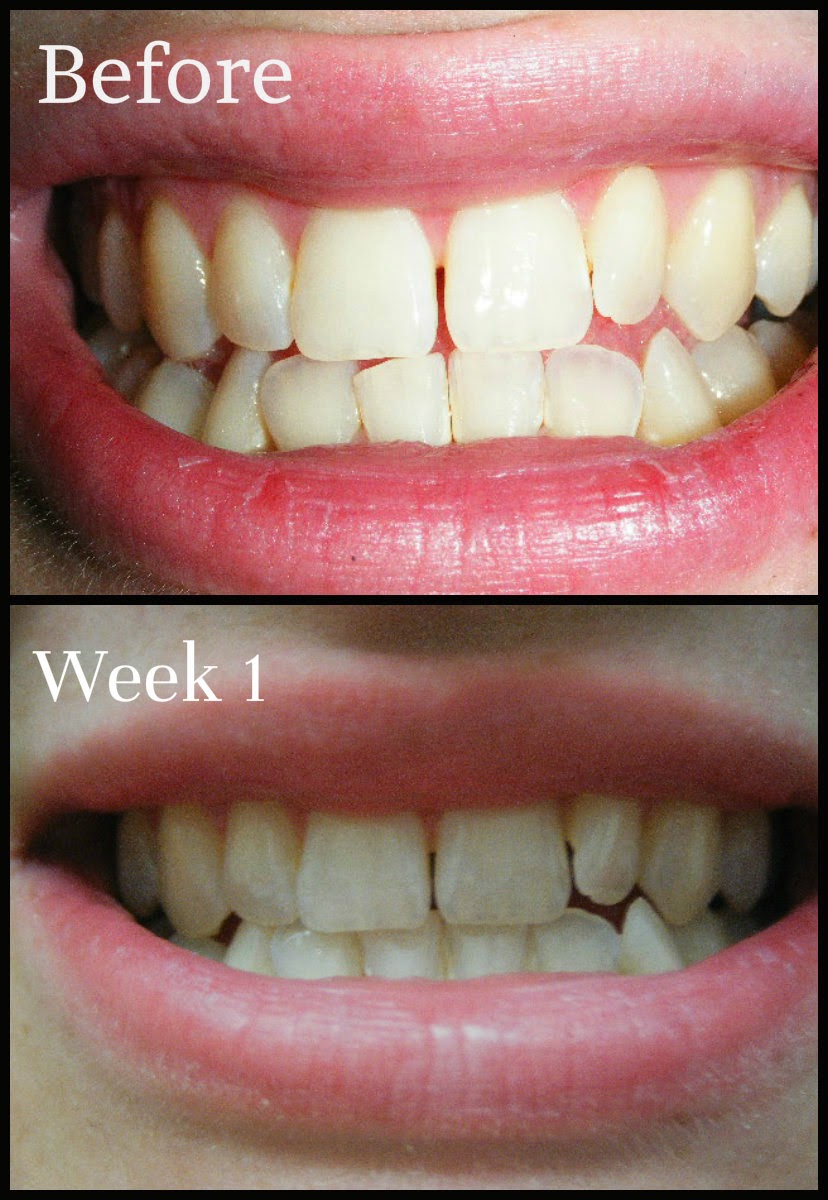 My Invisalign Smile: Week 1 (Including Pictures)