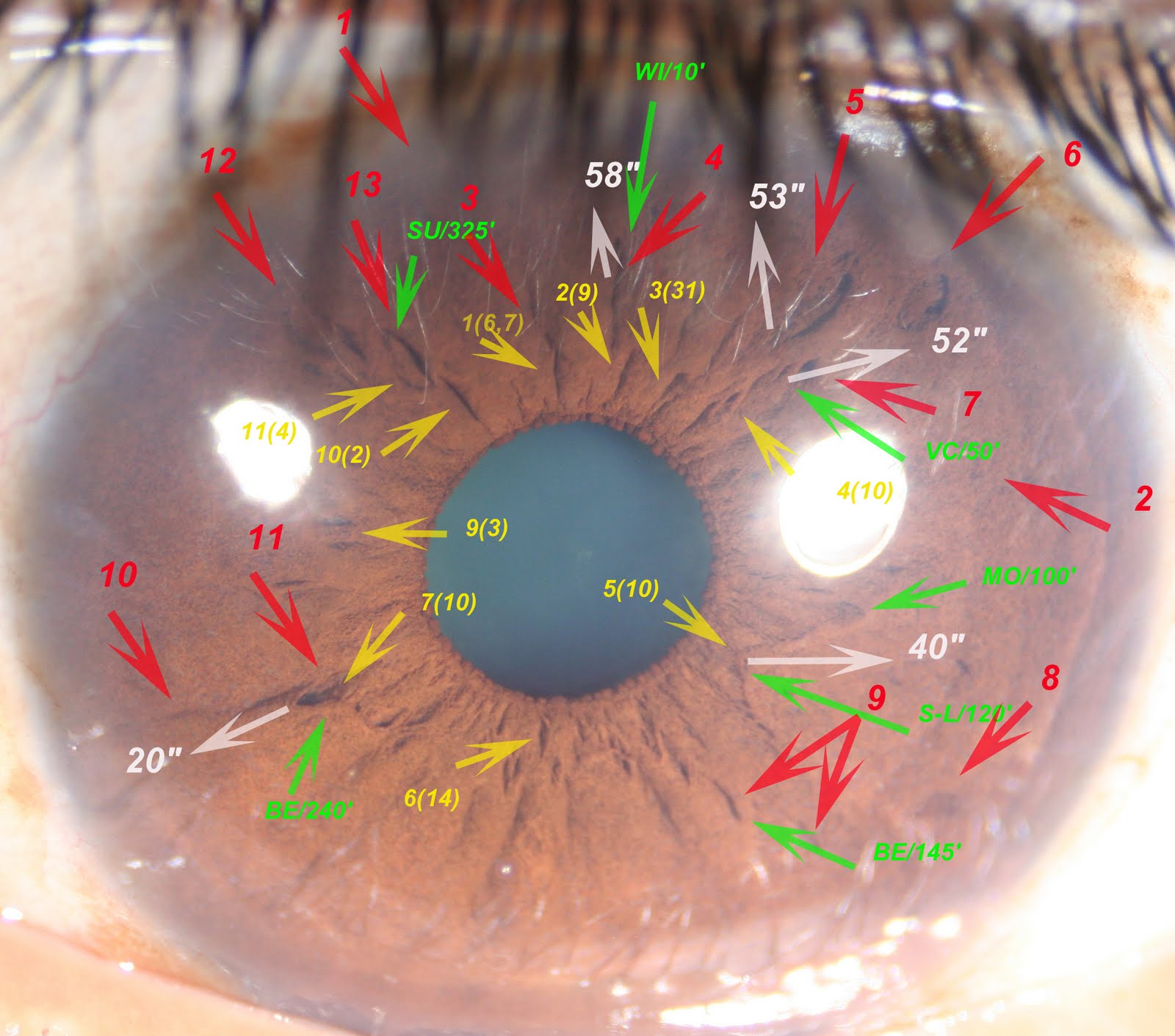 Modern & Multidimensional Iridology: Multidimensional Iridology Analysis